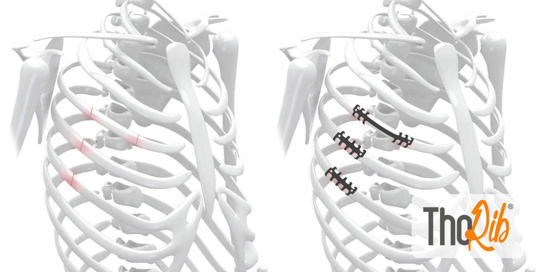 ThoRib® - Neuro France implants